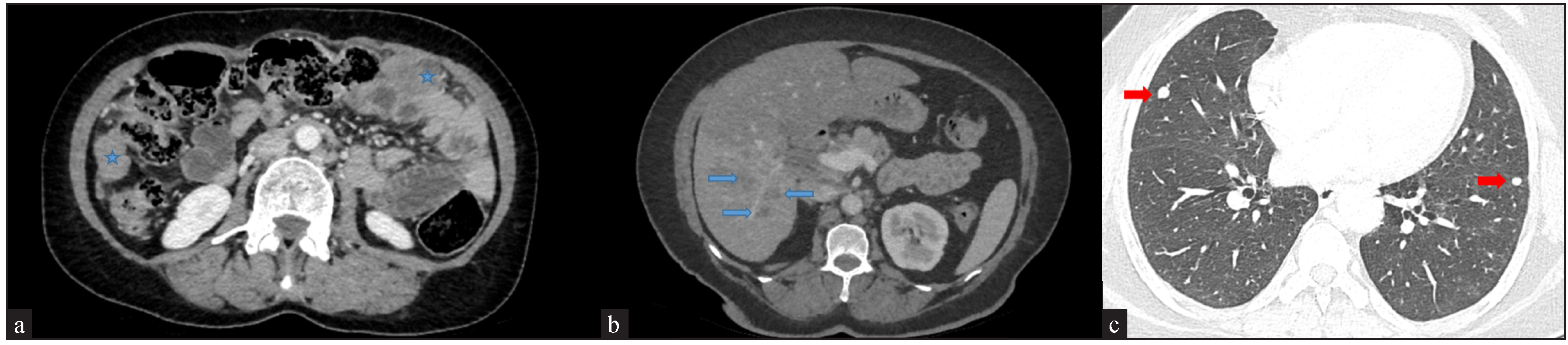 Disseminated Kaposi sarcoma with cutaneous lesions on a surgical scar ...
